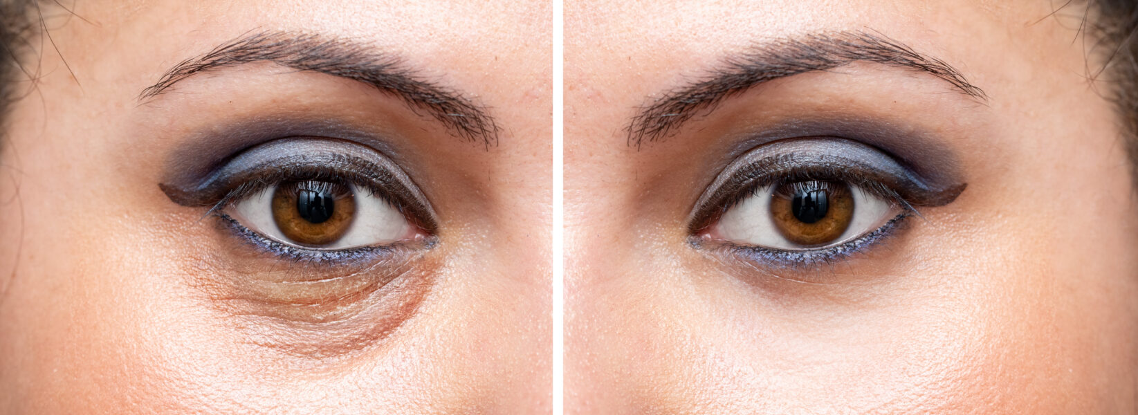 Oculofacial Plastic Surgery - Restore & Rejuvenate Your Eyes - SightMD